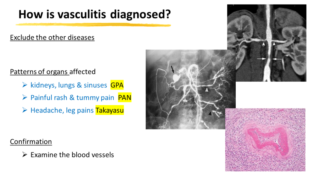 Vasculitis - Cassie and Friends Society